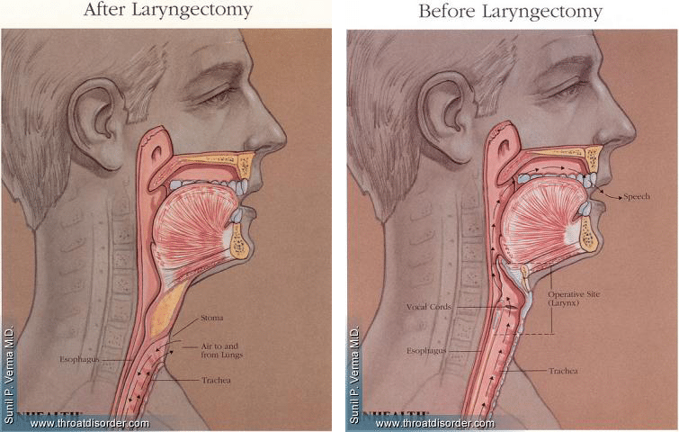 Laryngectomy | Southern California, Orange County, Otolaryngology ENT