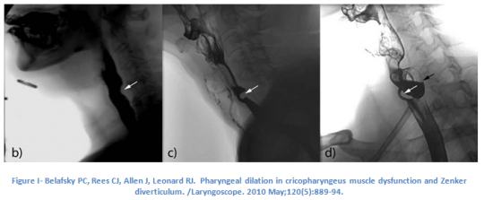 Zenker's Diverticulum | Southern California, Orange County ...